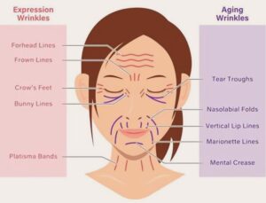 Bunny Lines Botox | Wrinkles Beside The Nose | Dr Majid Shah